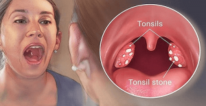 4 Maneras eficaces de quitar la infección en las amígdalas sin cirugía ...